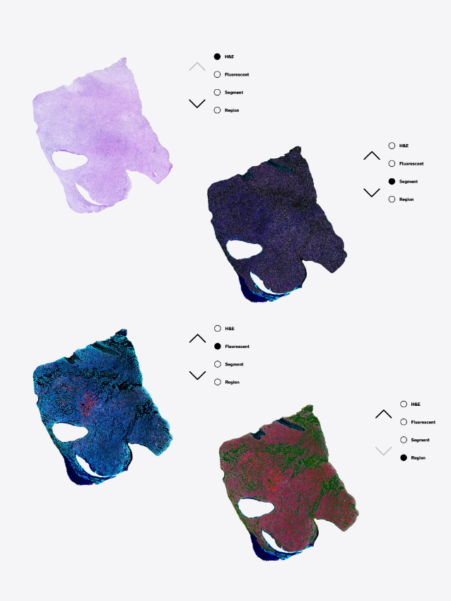Tissue Multiplex Analyte Detection in Anatomic Pathology - Pathways to ...